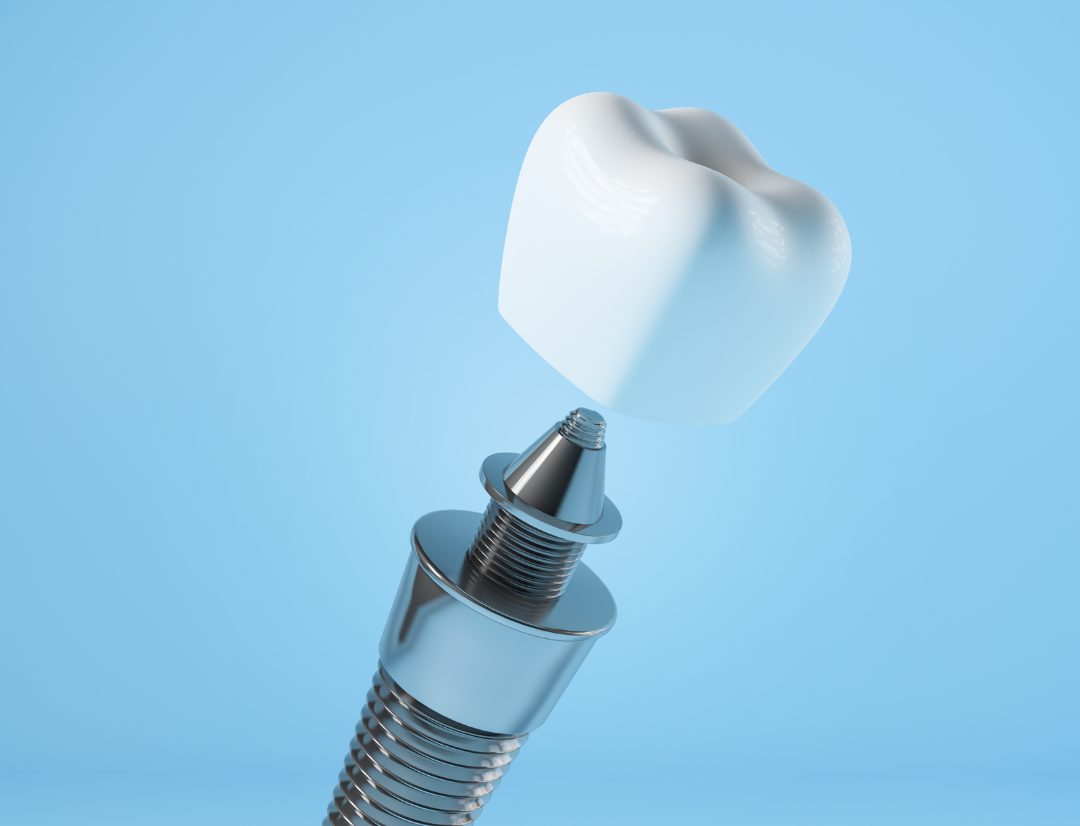 CEREC Dental Crowns: Same-Day Restorations with Experienced Providers